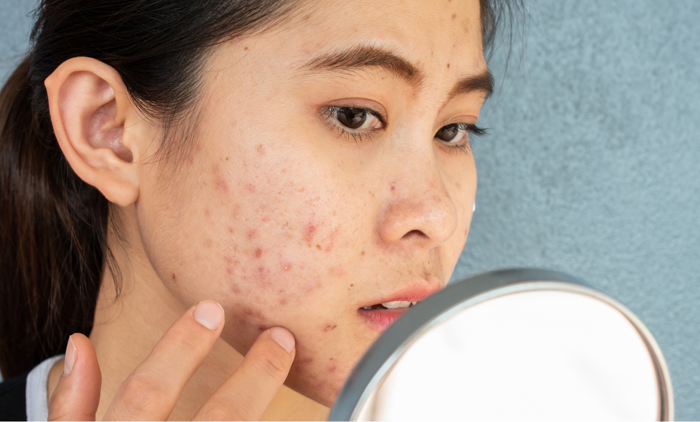 Everything You Need To Know About Acne Scarring - SkinLab
